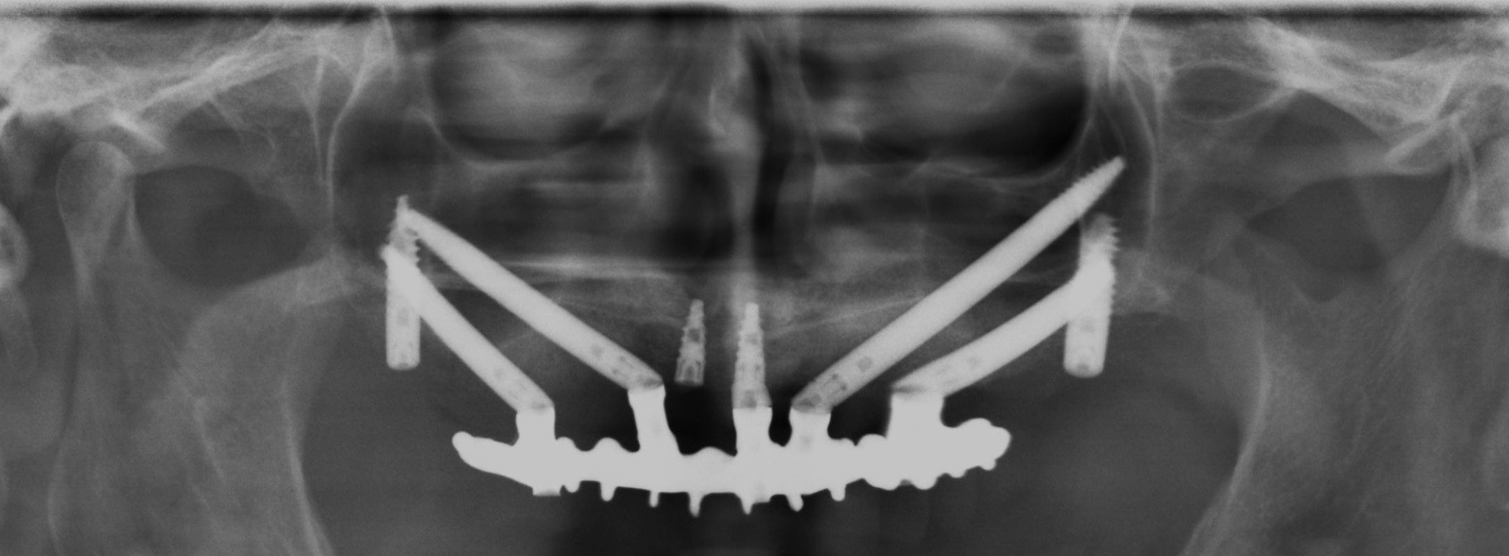 3 Day Clinical Course Zygoma with Live Surgery - Tel Aviv - Kaplavi ...